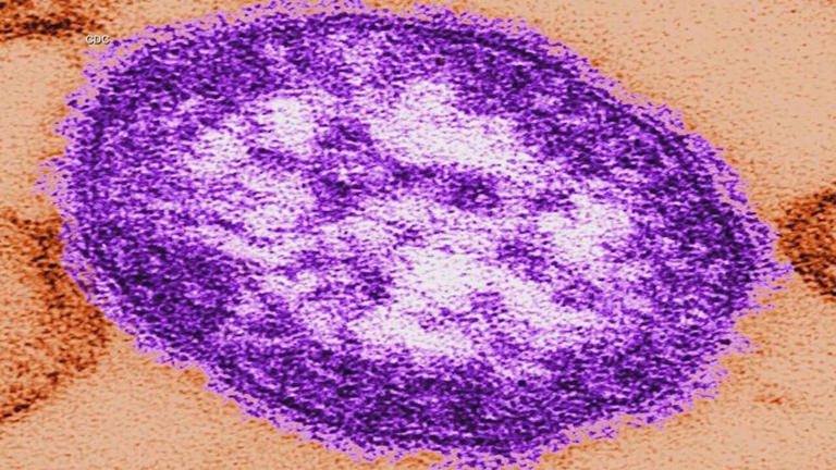 Maryland resident with measles traveled through Dulles, DC clinic