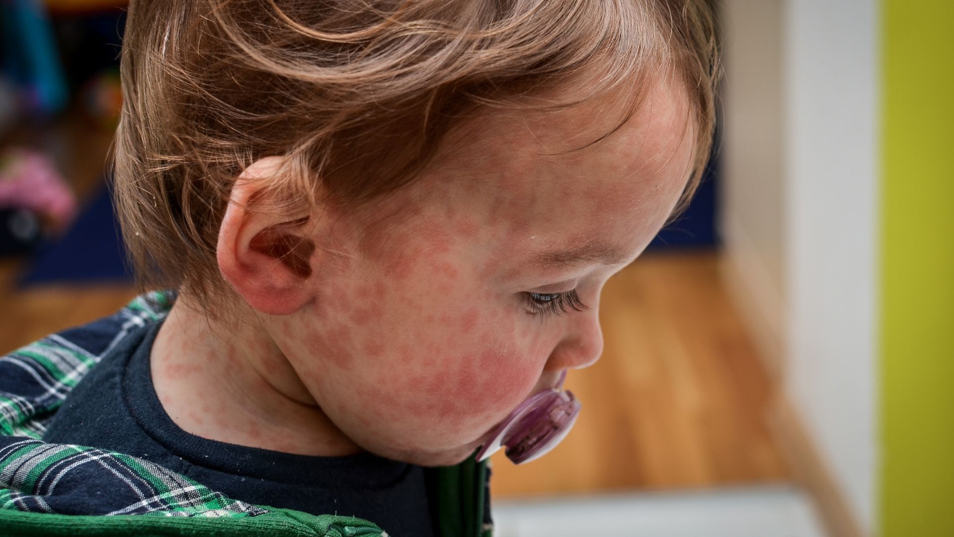 Measles outbreak in South Carolina climbs to 188 cases