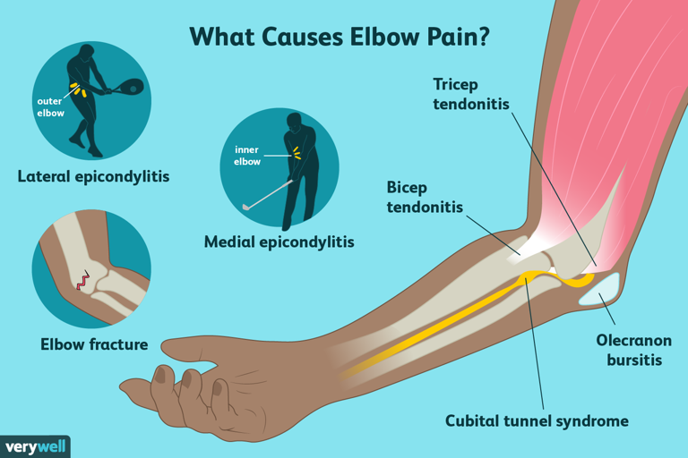 Everything you need to know about tennis elbow