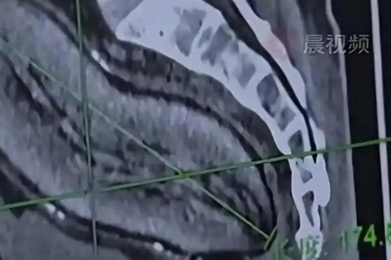 Giant potato wedged in bloke's bum leaves doctors baffled