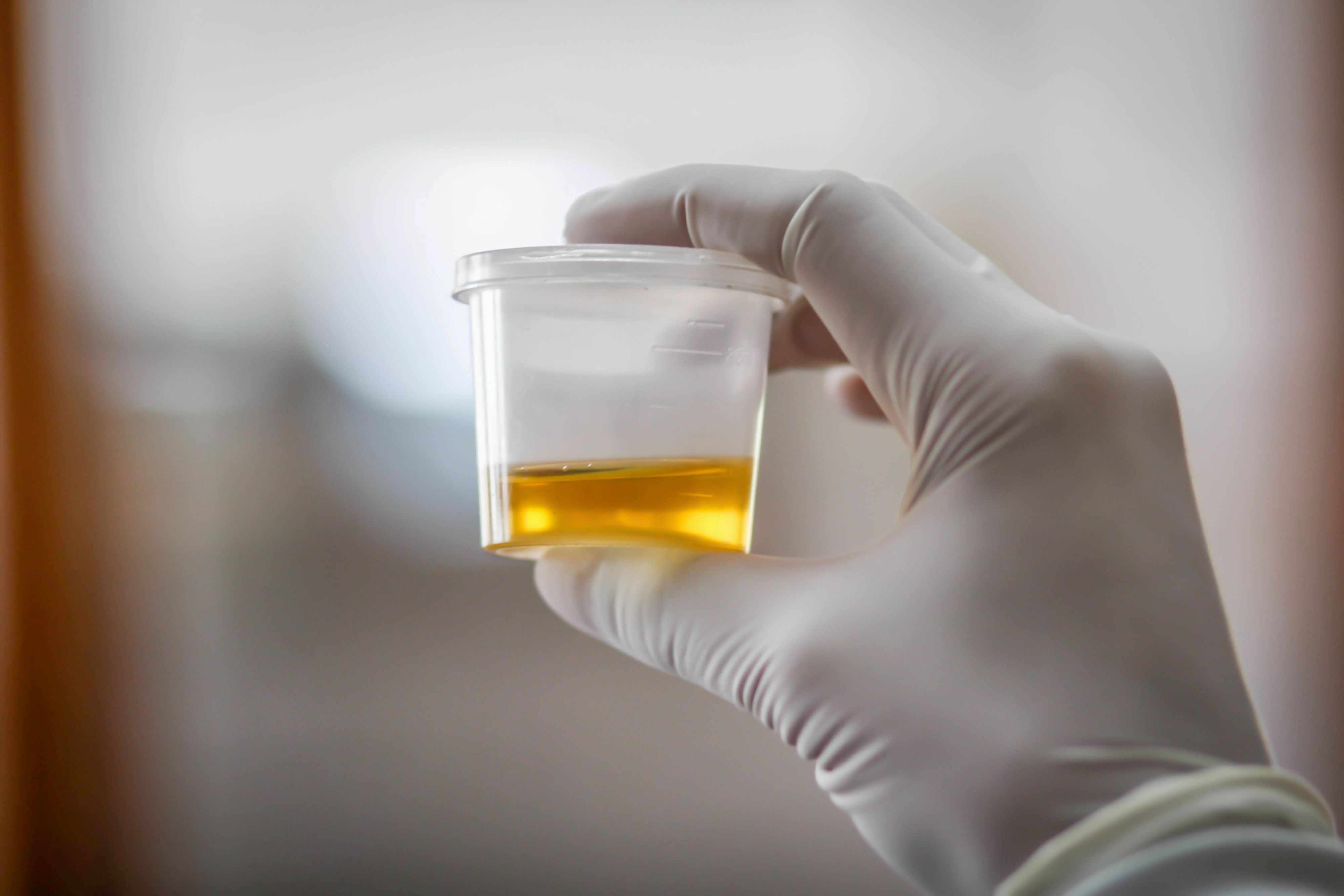 Proteinuria in complement 3 glomerulopathy: Why it matters and what to do