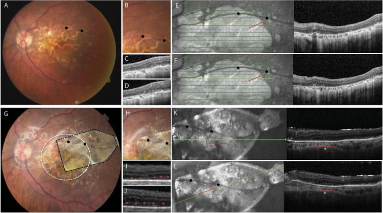 Tiny eye implant could restore vision lost to macular degeneration