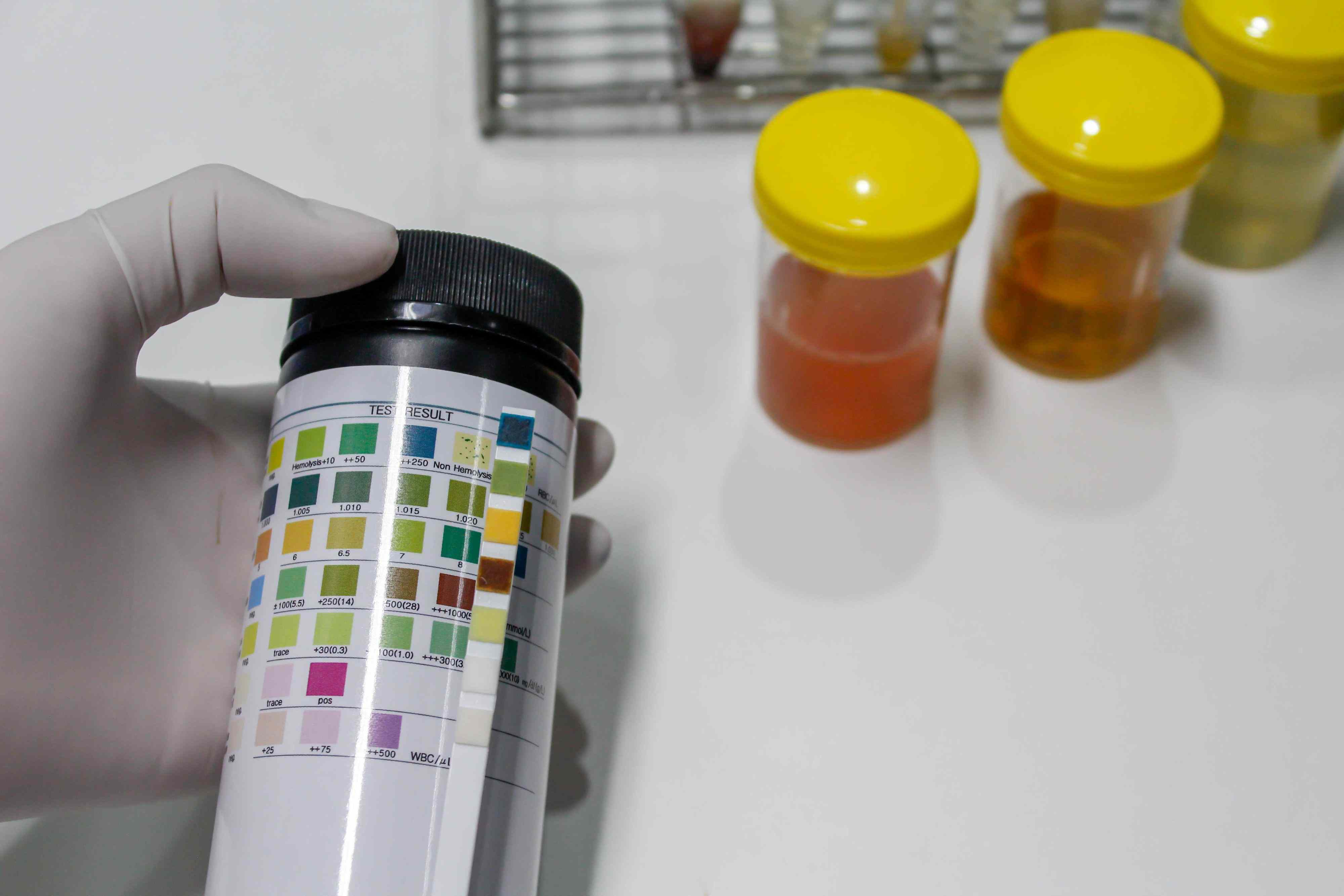 5 early signs and symptoms of IgA nephropathy