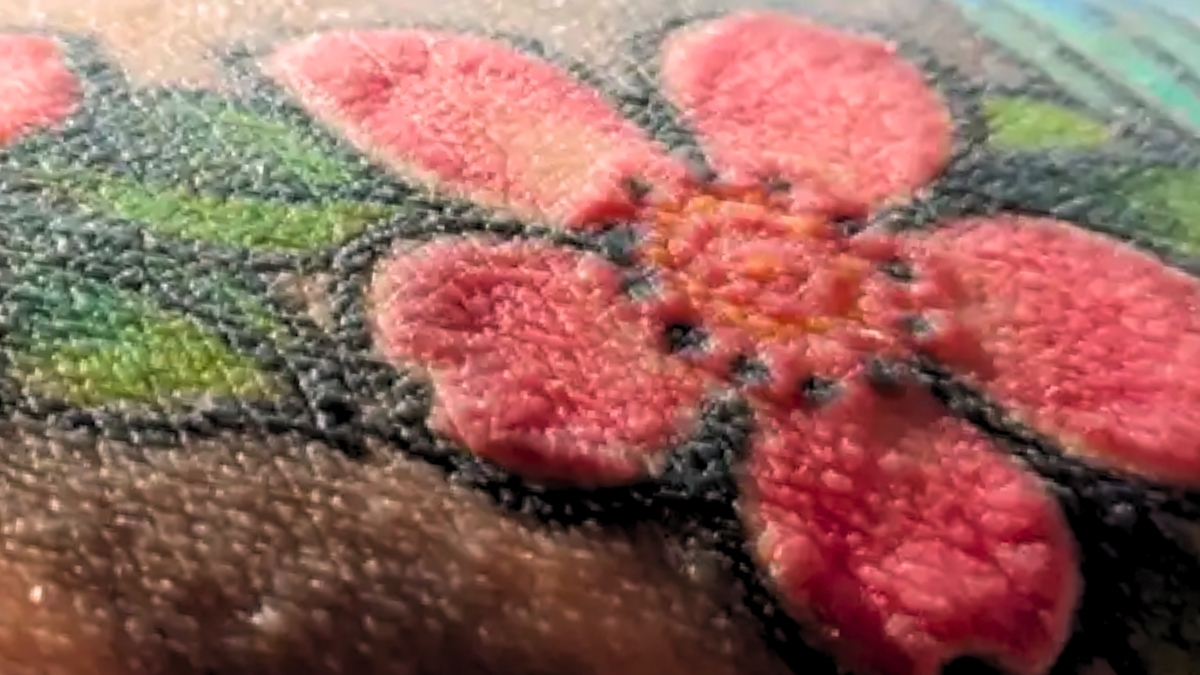 Red tattoos triggered shocking immune reactions in Polish man