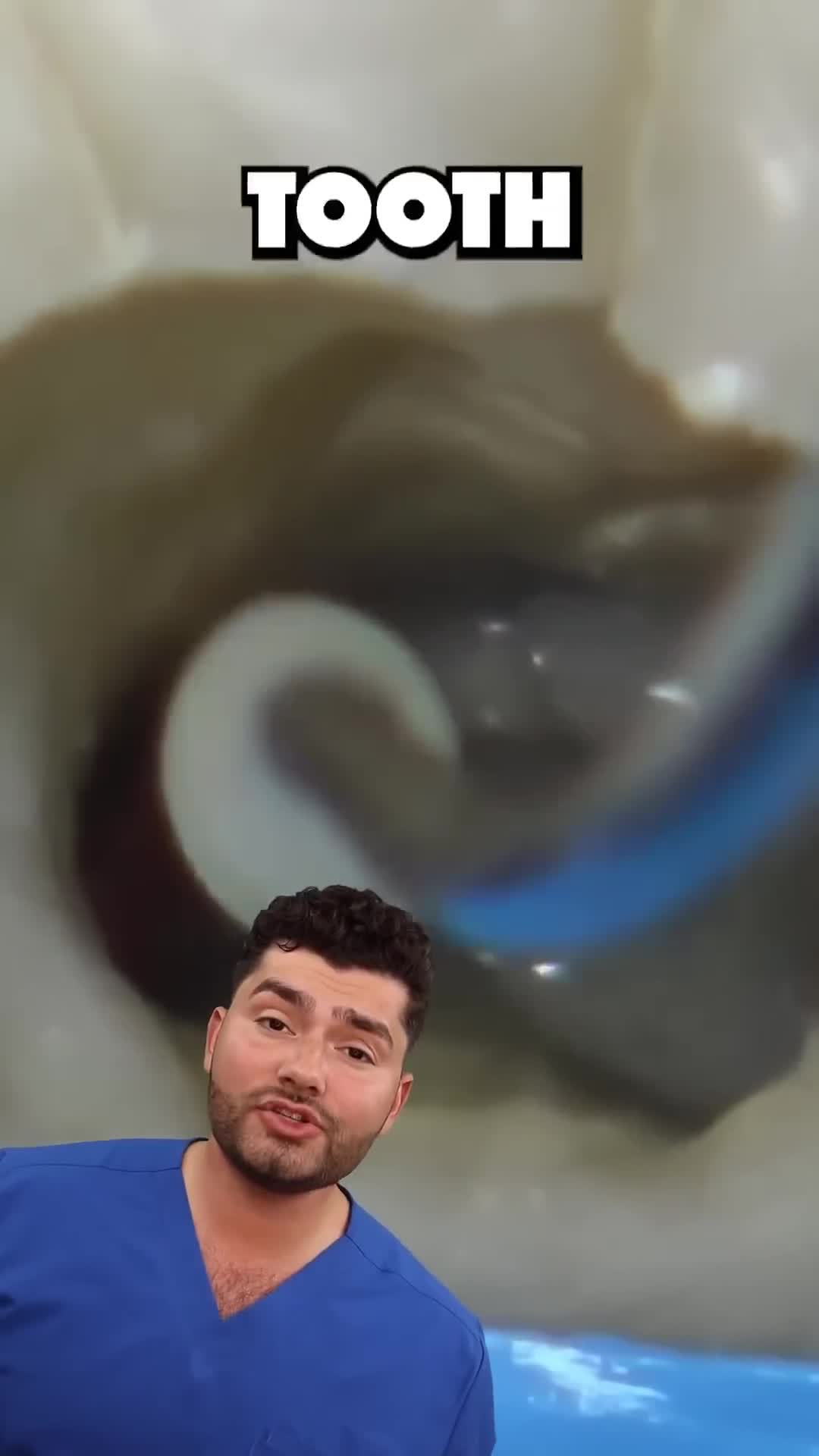 Root canal explained?