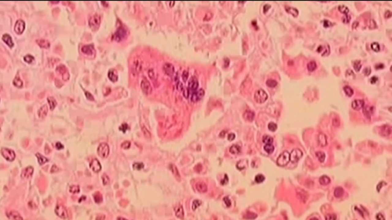 Officials: Infant in coastal Georgia contracts measles