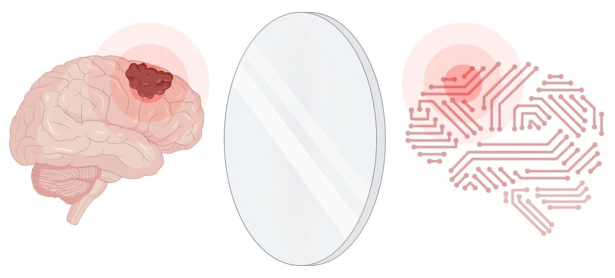 Brain cancer digital twin predicts treatment outcomes by mapping tumor ...