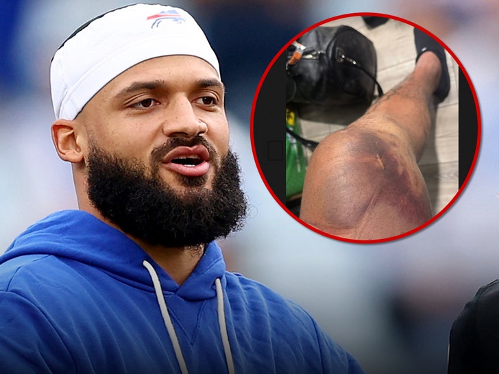 Buffalo Bills WR Gabe Davis shows off busted knee, coach confirms torn ACL