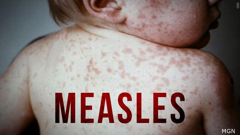 Case of measles confirmed in Northern Virginia