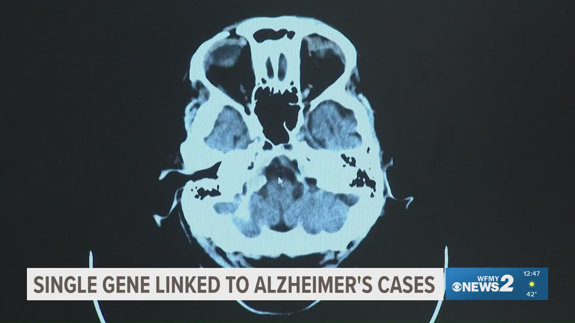 Single gene linked to most Alzheimer's cases