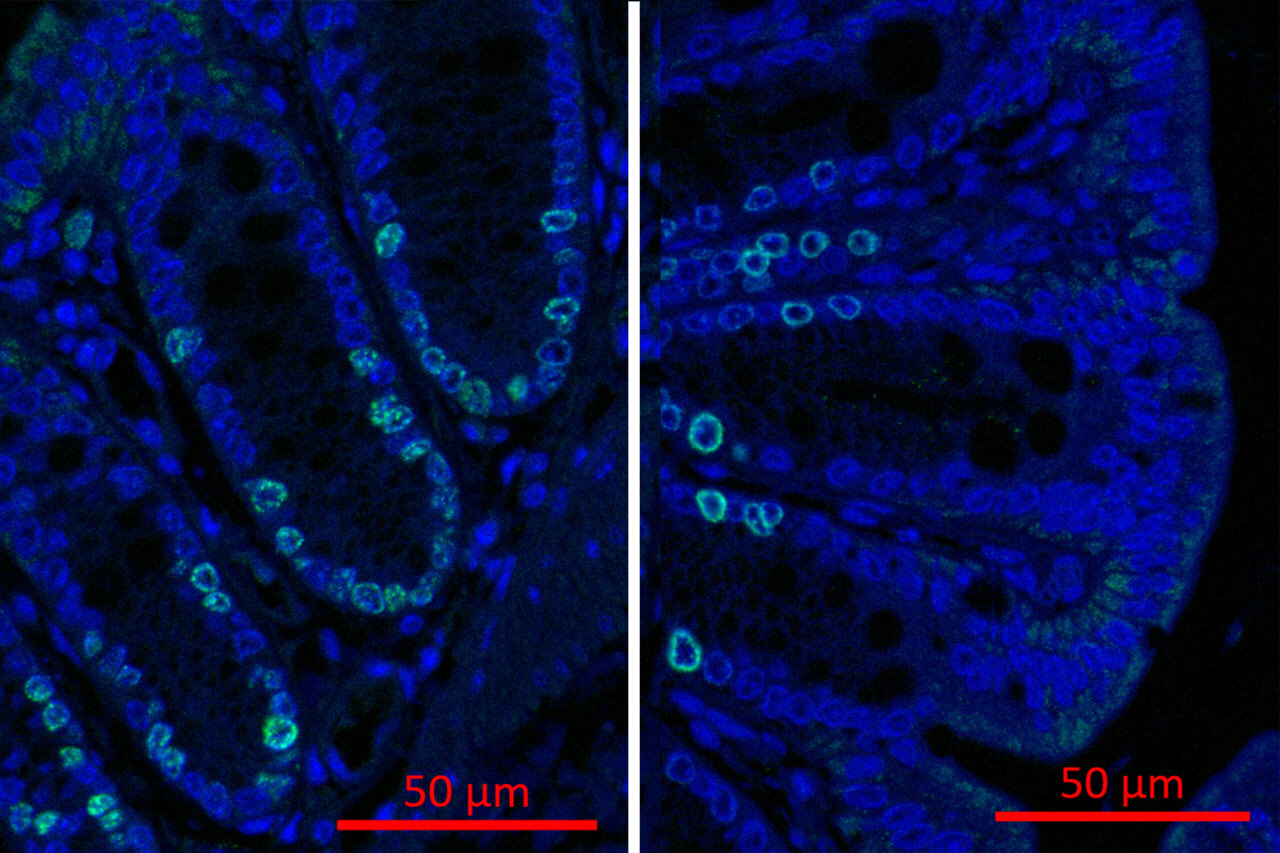 Microbially produced secondary bile acids accelerate colorectal cancer ...