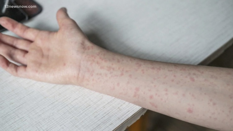 'Deaths I've seen are now preventable': Virginia reports second measles ...