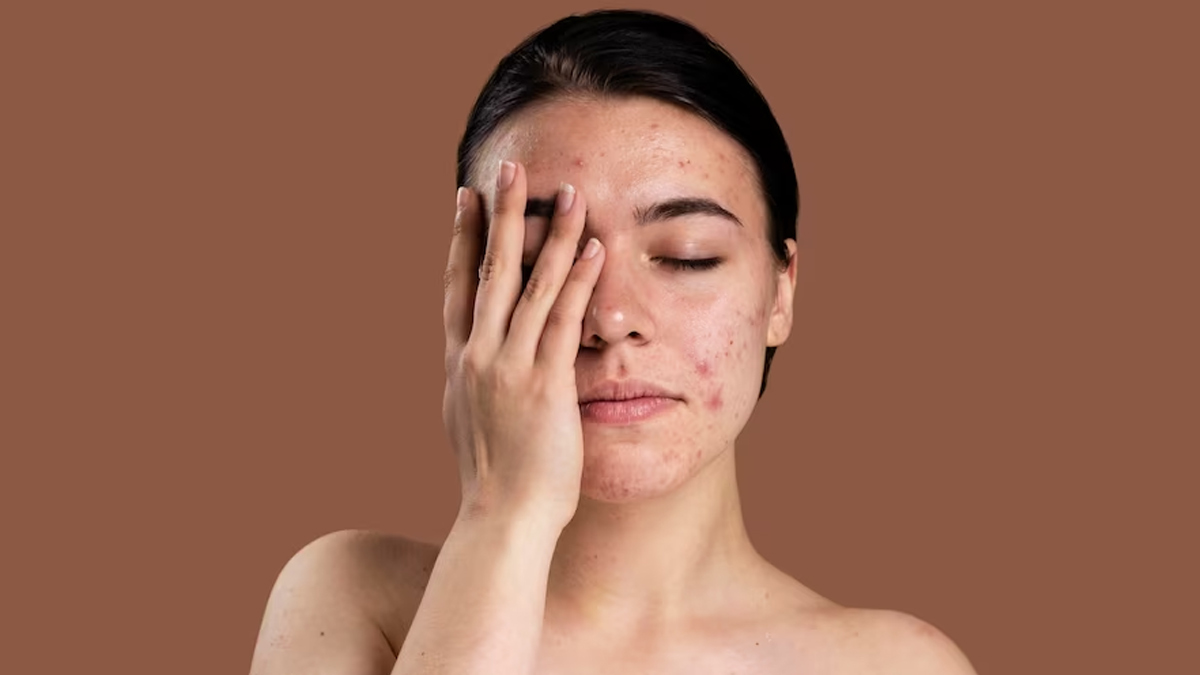 Can moisturisers cause acne? Dermatologist debunks myths
