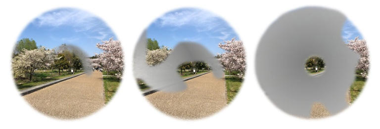 Common eye ointments linked to swelling and rupture of glaucoma implants