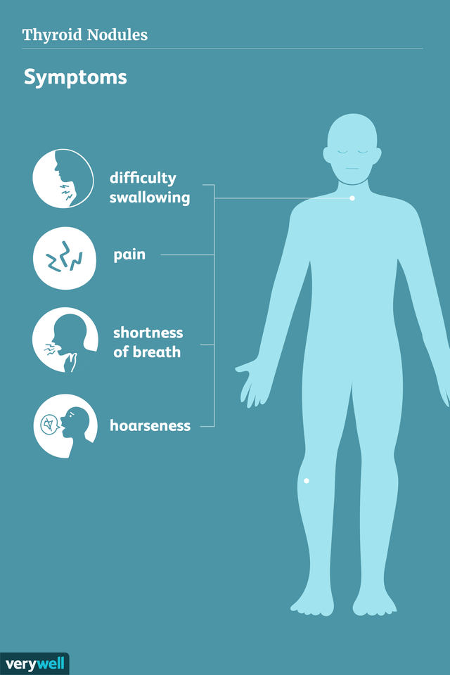 Thyroid nodules: Causes and treatment