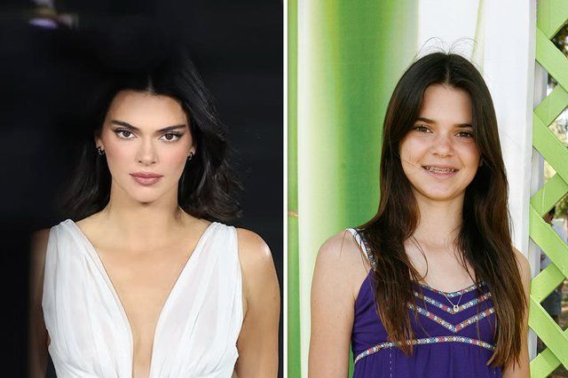 Kendall Jenner denies having plastic surgery
