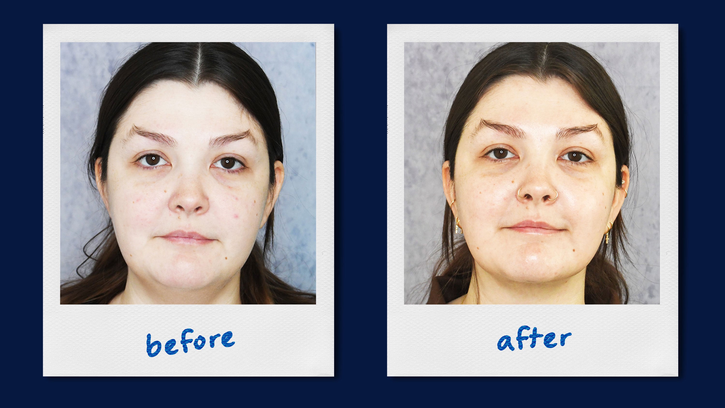 How 20-minute chin liposuction changed my whole face