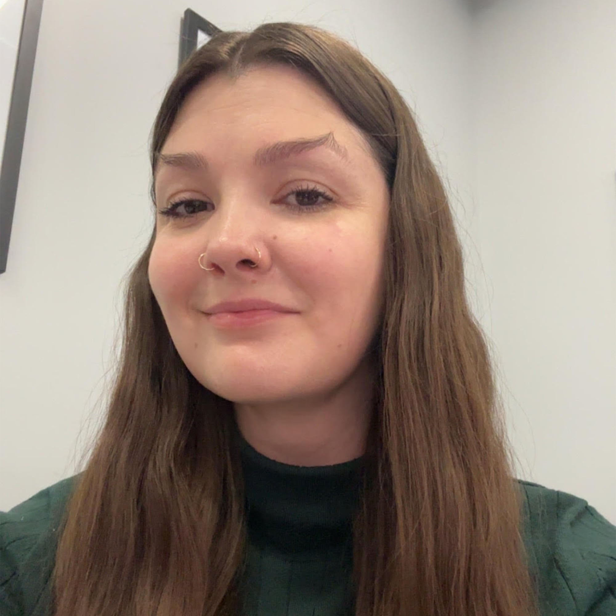 How 20-minute chin liposuction changed my whole face