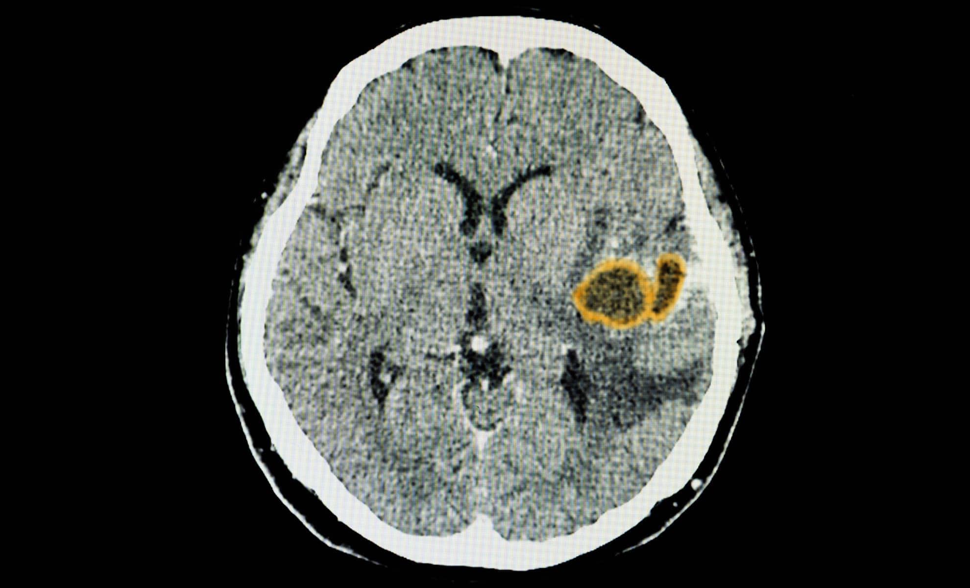 Brain parasite hijacks immune cells and uses them to survive