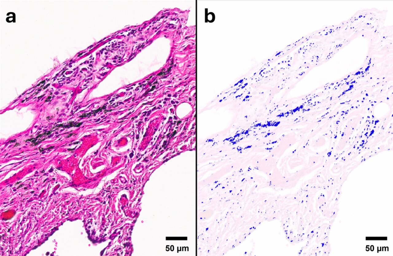 Study links burn pit smoke exposure to increased lung particle burden ...