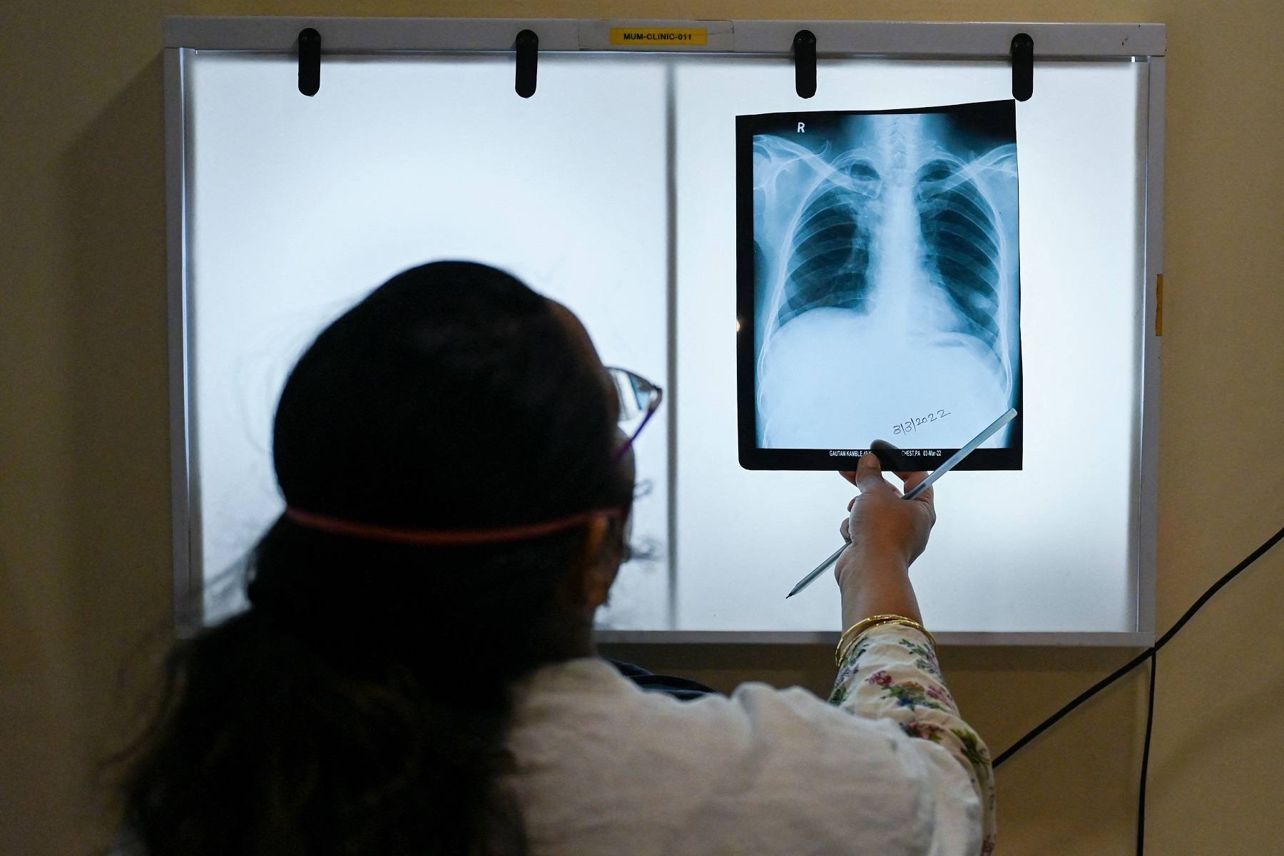 Tuberculosis: warning signs of 'Victorian disease' after outbreak at ...