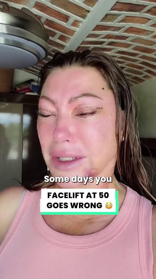 I'm not happy with my face lift