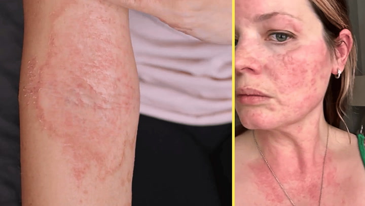 Can cold really cause an allergic reaction?