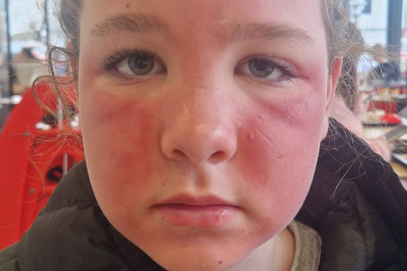 This £3.50 Primark cleanser caused my daughter's skin to peel off - it ...