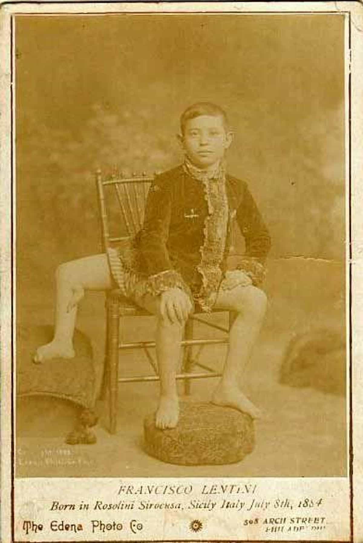 Facts and stories about Frank Lentini, the 'three-legged man'