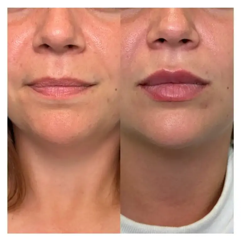 La hidratación de labios es el tratamiento con el acabado más natural