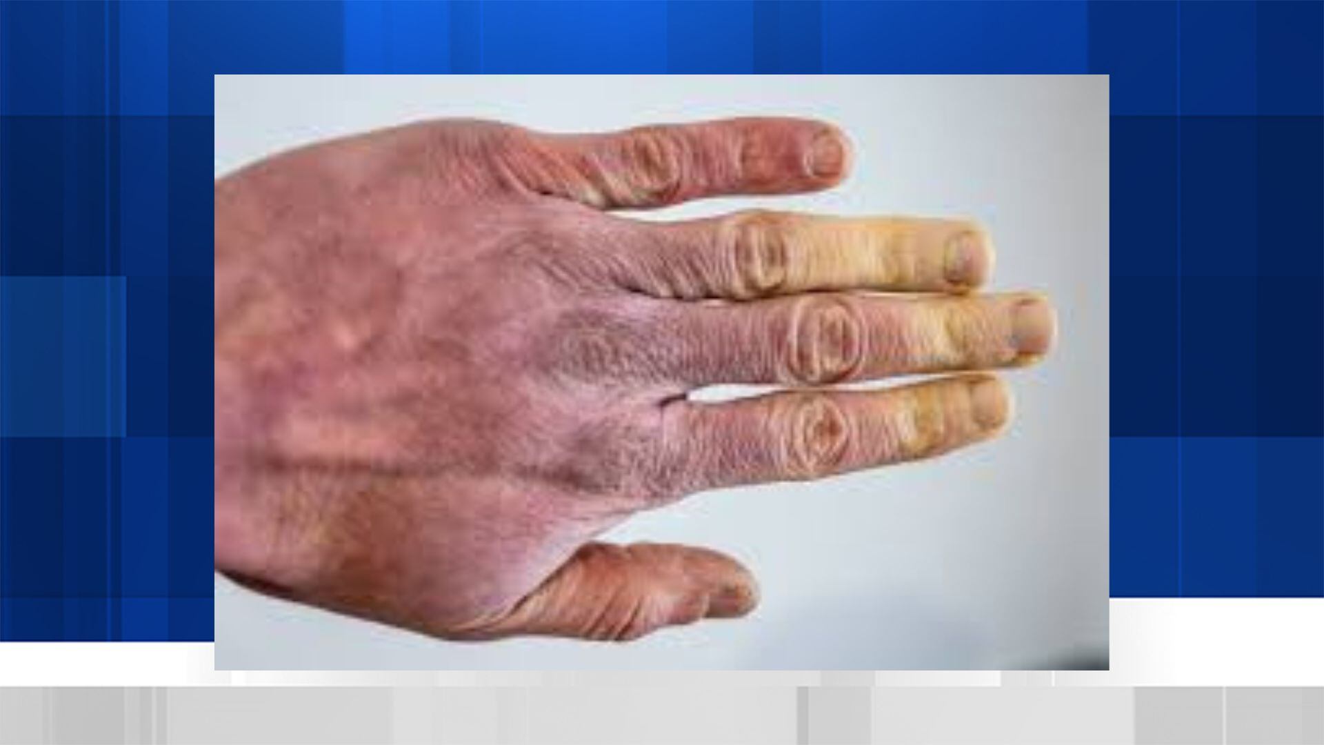 Medical experts share frostbite tips and how to prevent it