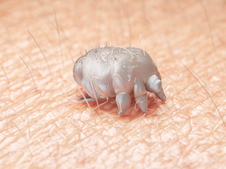 Scabies is on the rise – and no one knows why