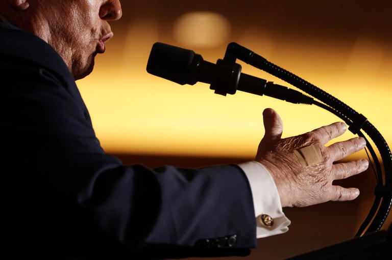 Trump's hand more bruised than ever in graphic photo as painful mark ...