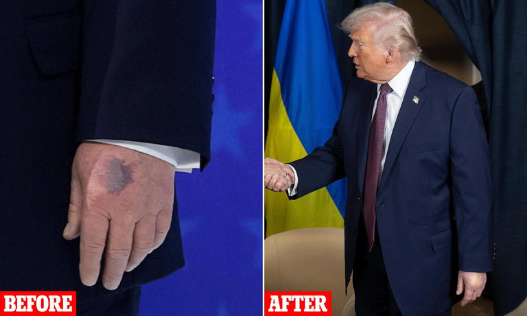 Trump is seen wearing thick make-up to cover up bruising on his hand ...