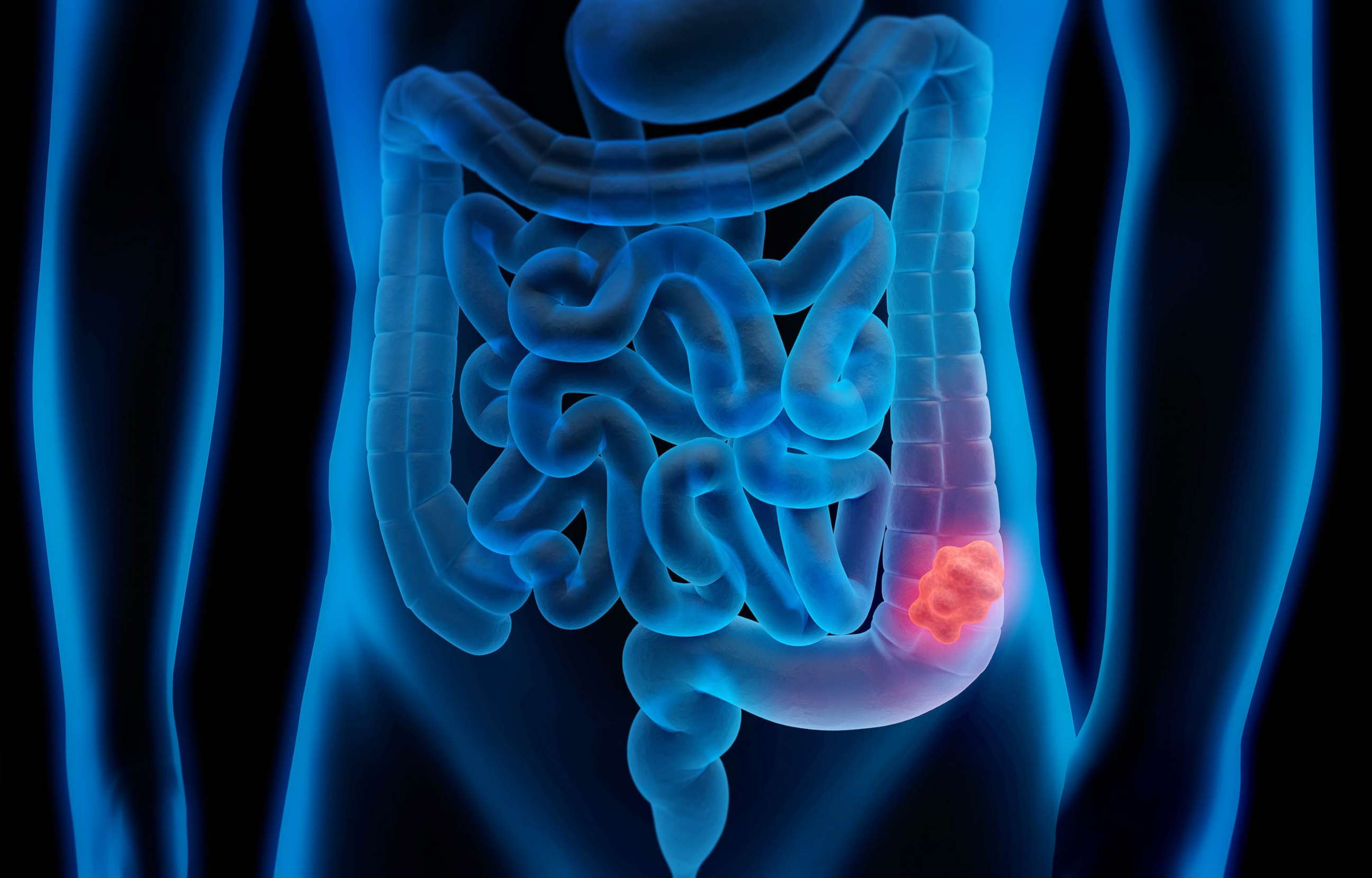 Colon cancer deaths in US on the rise in this age group, study finds