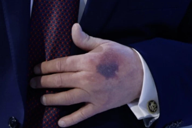 Trump's hand more bruised than ever in graphic photo as painful mark ...