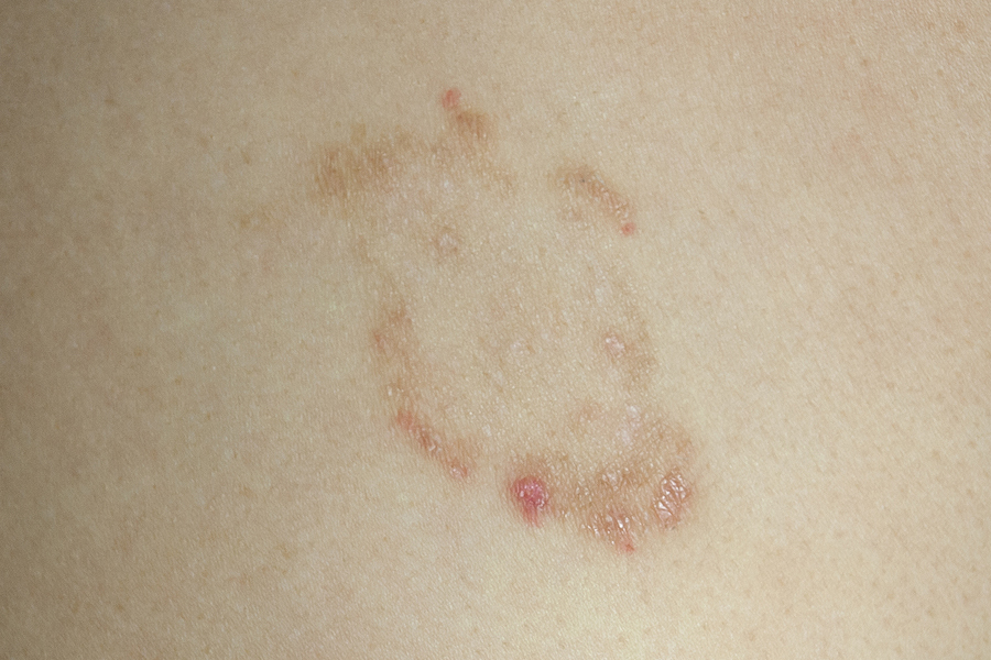 Ringworm explained in 5 photos (what to look for)