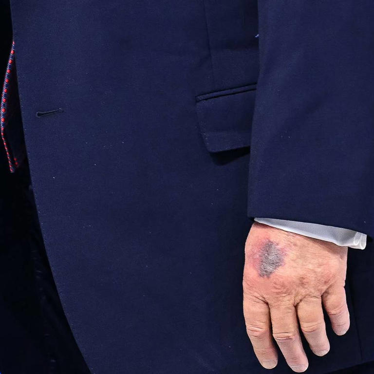 Weißes Haus erklärt Bluterguss an Trumps Hand – hat mit „Friedensrat ...