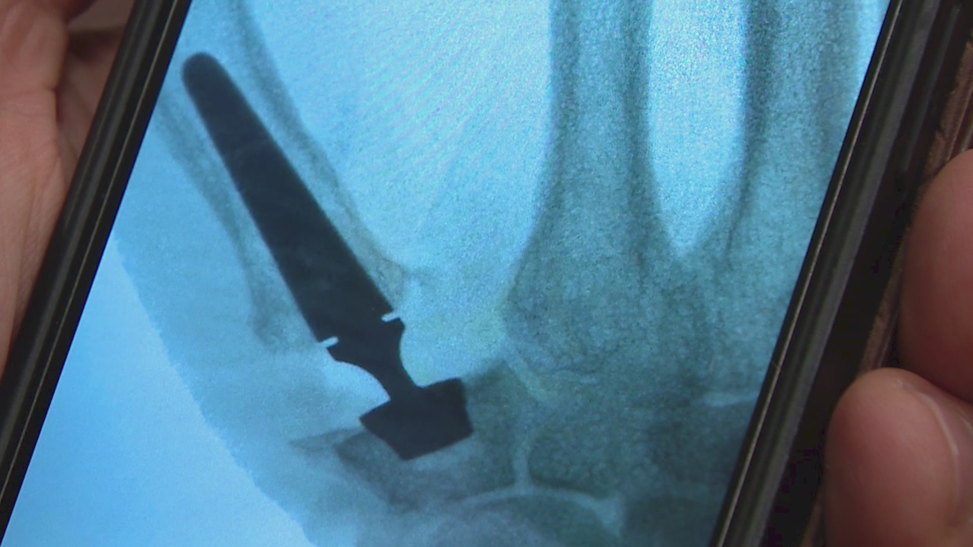 Tiny device offers hope for those with thumb joint pain