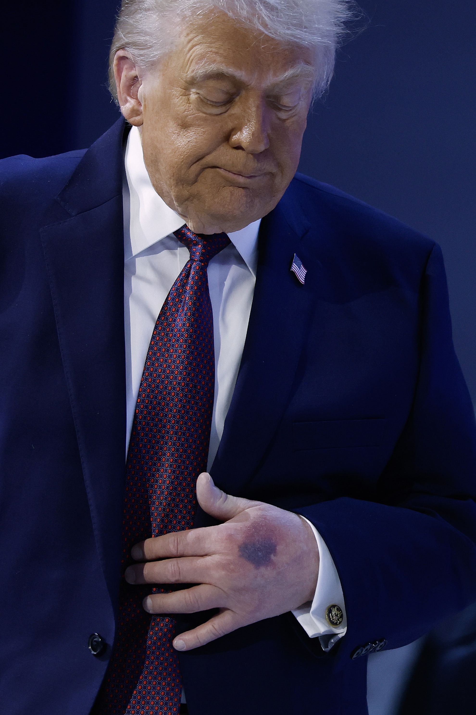 Enormous bruise spotted on Donald Trump's hand