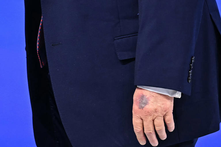 Donald Trump reacts to new bruise on left hand