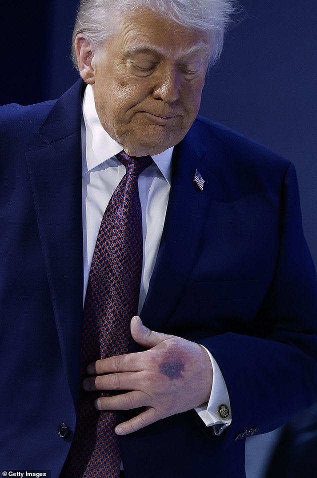 Trump explains how he got bruise on hand that sparked more health ...