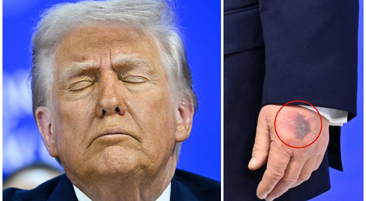 Donald Trump, i lividi alla mano (sempre più evidenti) e i discorsi ...