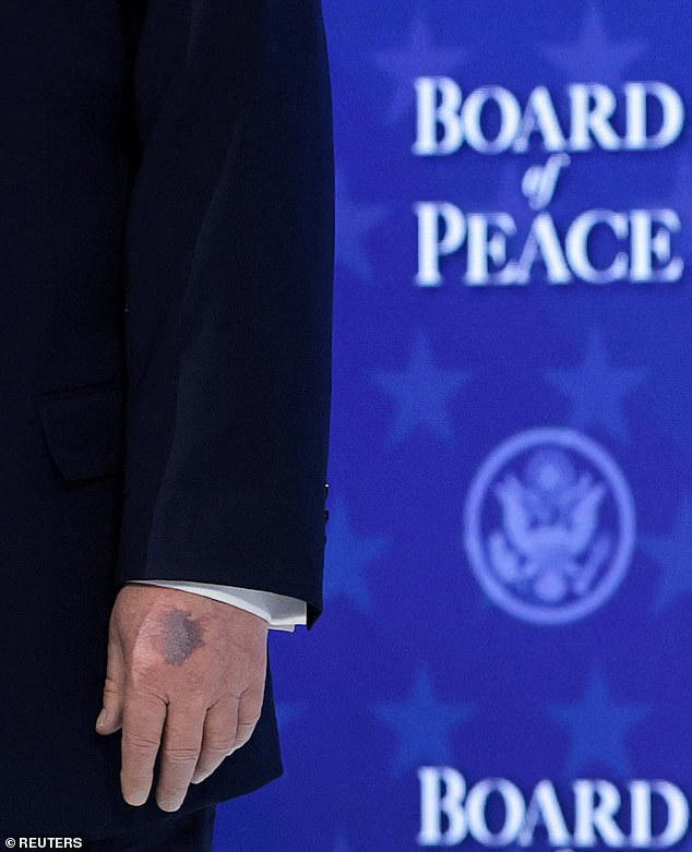 Trump is seen wearing thick make-up to cover up bruising on his hand ...