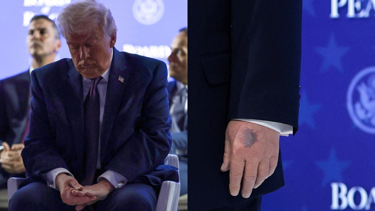 Photos reveal deep bruise on Trump's hand at Davos summit, he offers ...