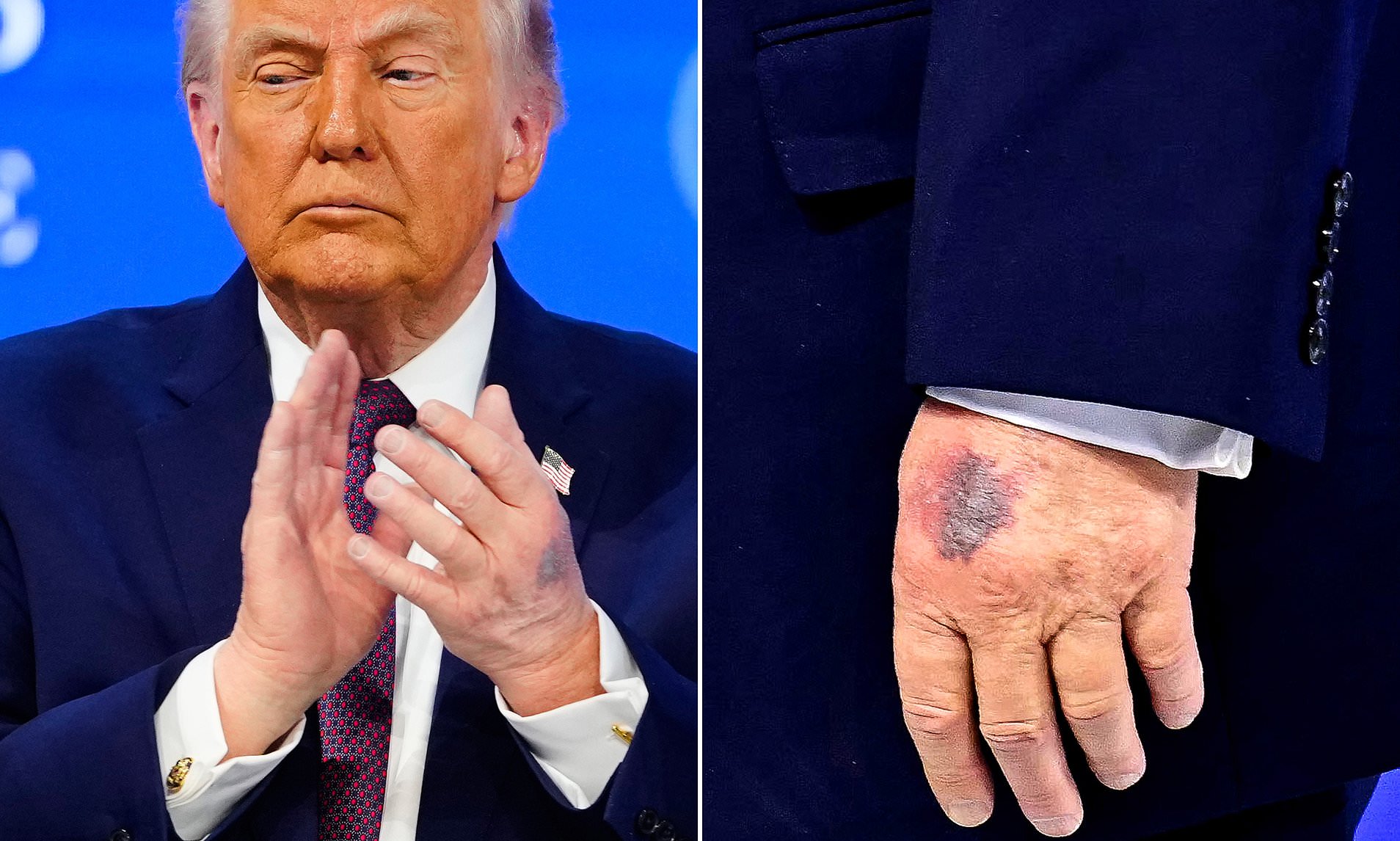 Trump describes excruciating moment that resulted in severe bruise on hand