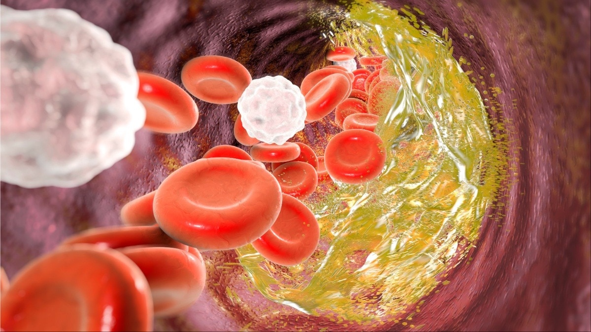 How to raise good cholesterol: Doctor shares 5 key lifestyle changes to ...