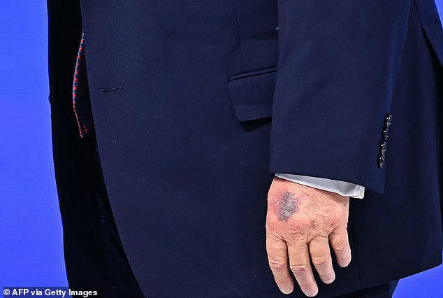 Trump explains how he got bruise on hand that sparked more health ...