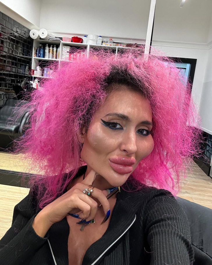 See 'Biggest cheeks in the world' star’s face before cosmetic procedures