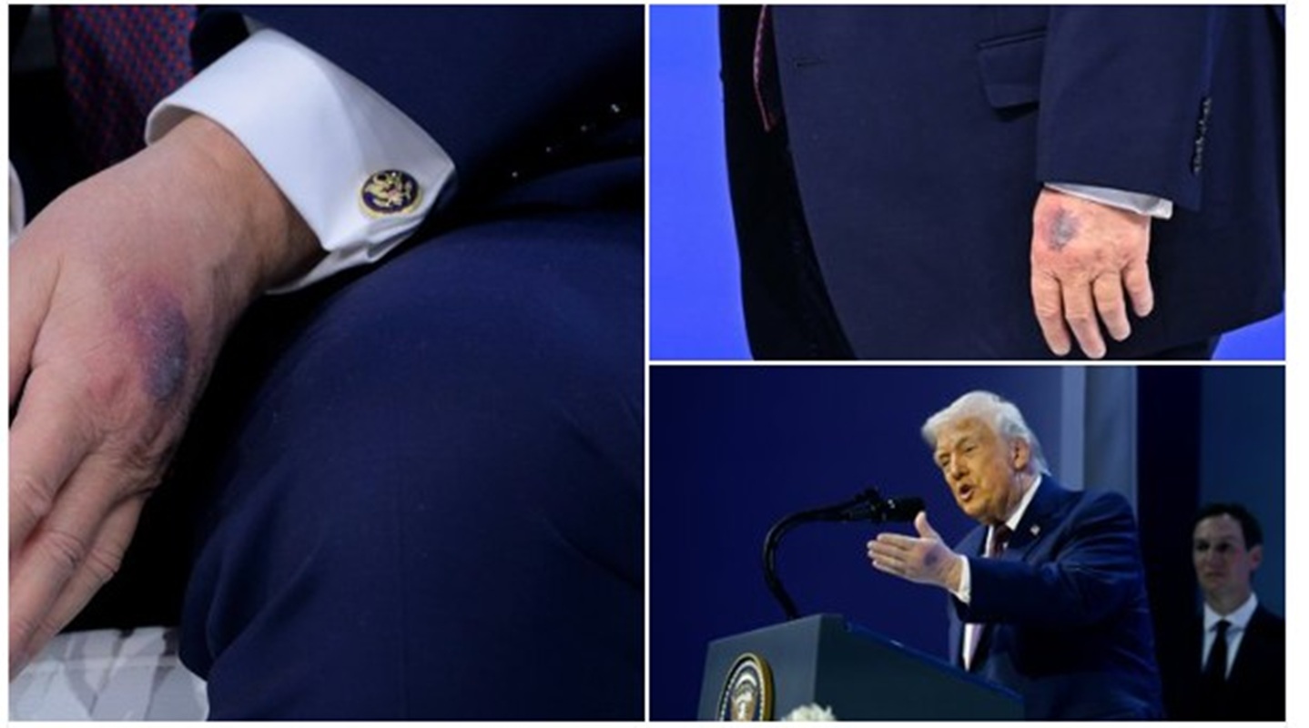 Il giallo del livido sulla mano sinistra di Trump: «L’ho sbattuta ...
